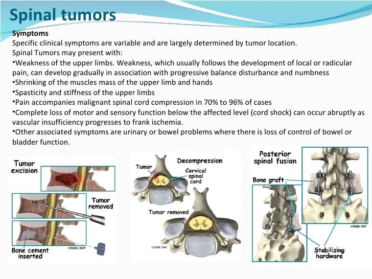 Spine Cancer Diagnosis at Gerald Jimenez blog