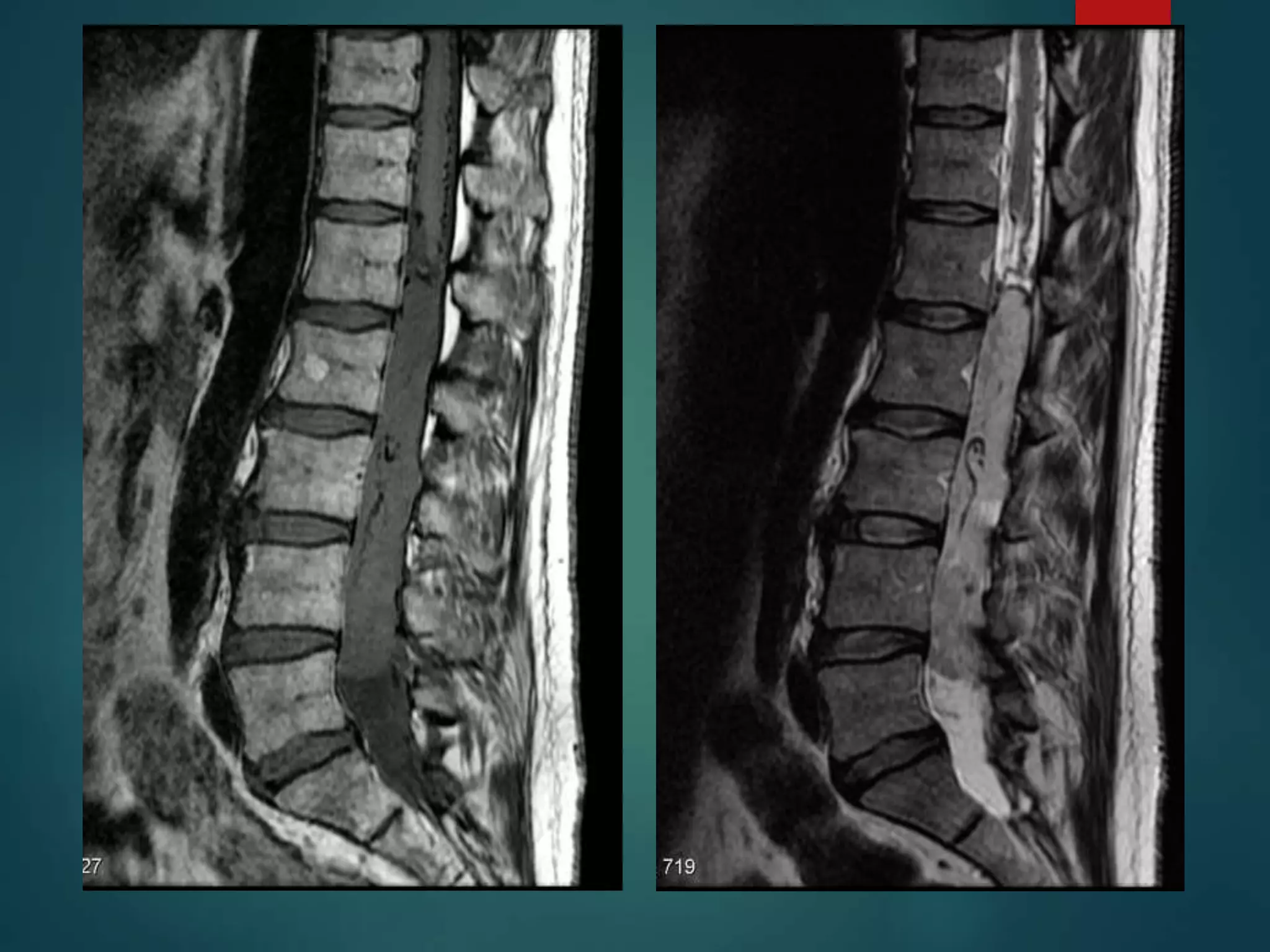 IMAGING OF SPINAL TUMORS | PPTX