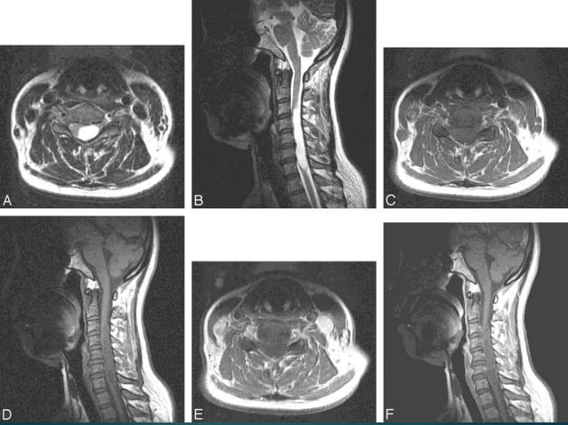 IMAGING OF SPINAL TUMORS | PPTX | Brain and Nervous System Disorders ...