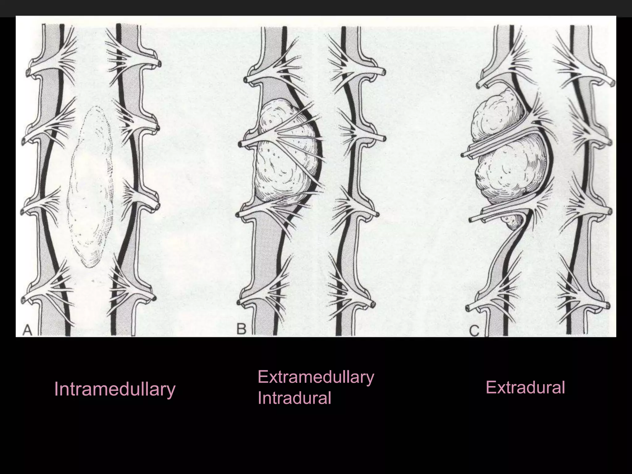 Imaging in spinal tumors | PPTX
