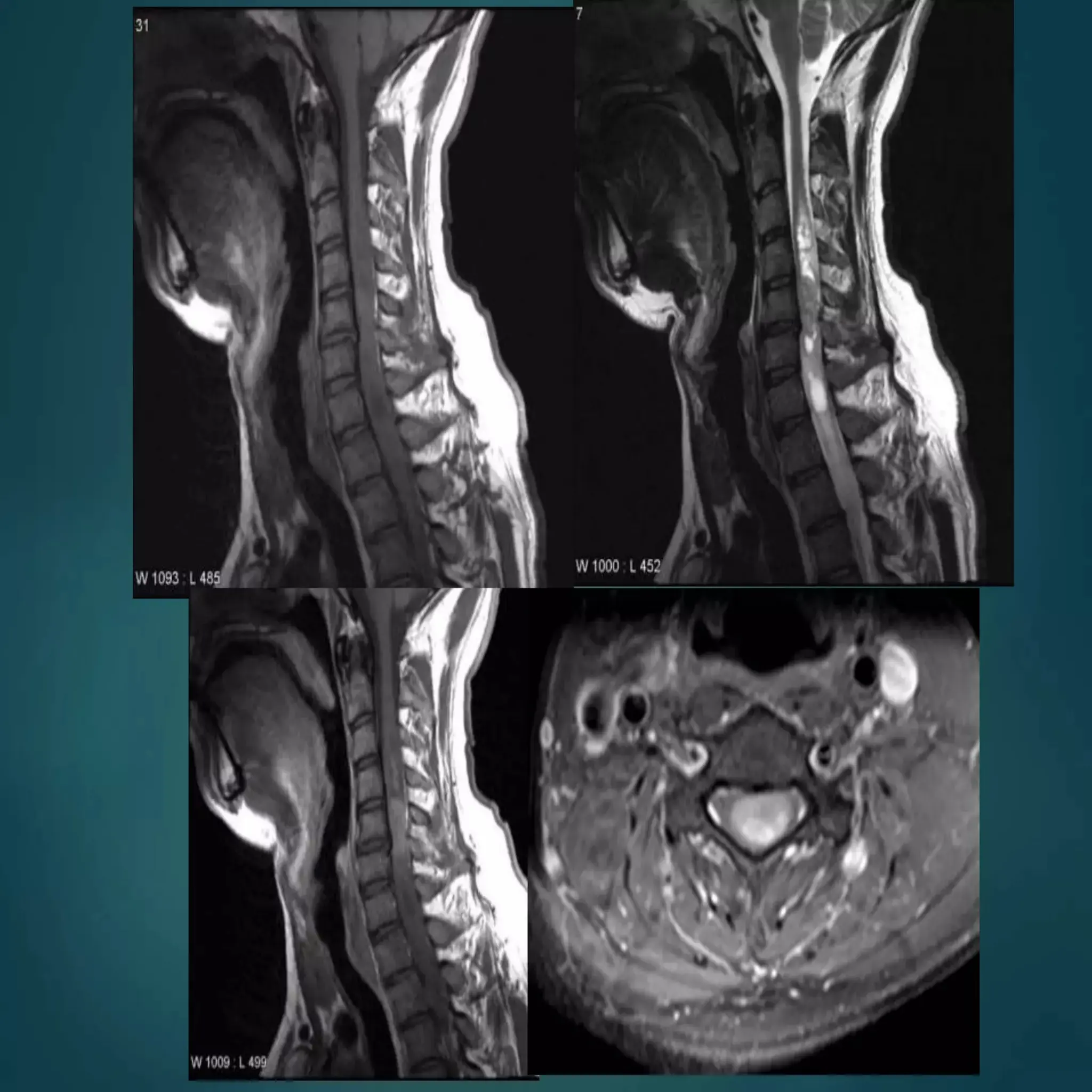 spinal tumors (extra -dural ,intra- dural extra- medullary imaging by ...