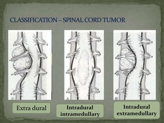 Spinal tumour lecture - copy | PPTX