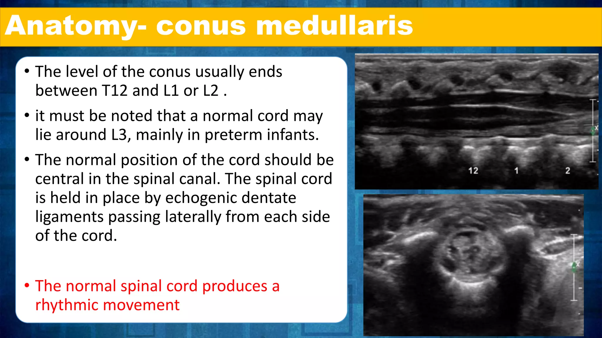 ULTRASOUND EXAMINATION OF INFANT SPINE - STEP BY STEP | PPTX
