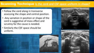 ULTRASOUND EXAMINATION OF INFANT SPINE - STEP BY STEP | PPTX