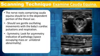 ULTRASOUND EXAMINATION OF INFANT SPINE - STEP BY STEP | PPTX