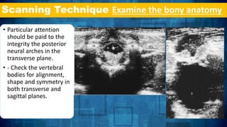 ULTRASOUND EXAMINATION OF INFANT SPINE - STEP BY STEP | PPTX