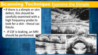 ULTRASOUND EXAMINATION OF INFANT SPINE - STEP BY STEP | PPTX
