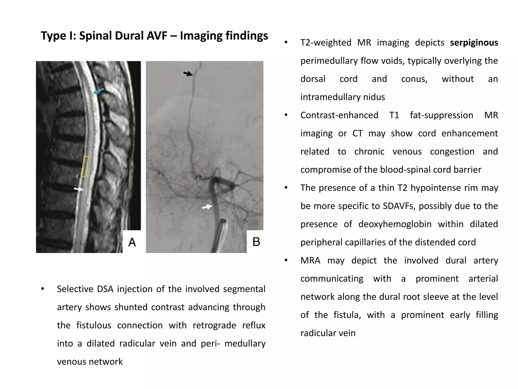 Spinal Vascular Shunts.pptx