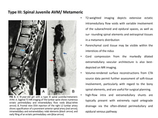 Spinal Vascular Shunts.pptx