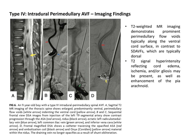 Spinal Vascular Shunts.pptx