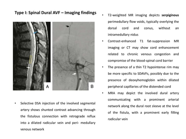 Spinal Vascular Shunts.pptx