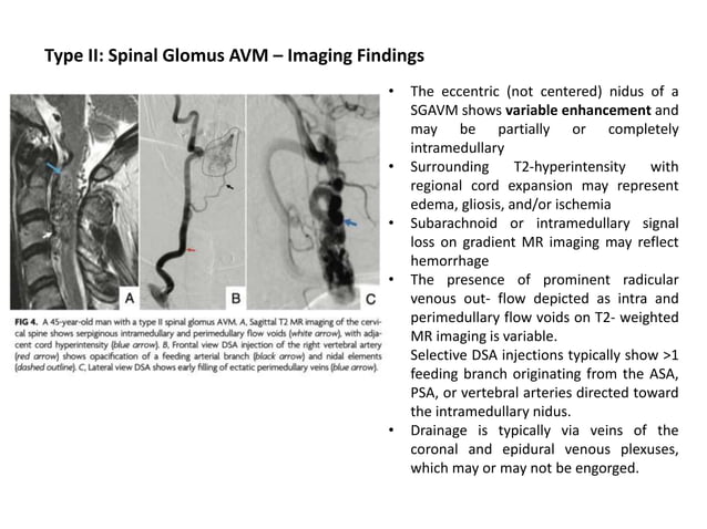Spinal Vascular Shunts.pptx