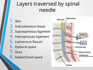 Spinal vs Epidural Anesthesia in labor - | PPTX
