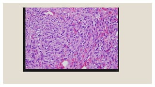 Spindle cell lesions of BREAST.pptx for md | PPTX
