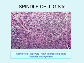 SPINDLE CELL LESIONS OF GIT .pptx