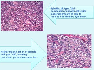 SPINDLE CELL LESIONS OF GIT .pptx