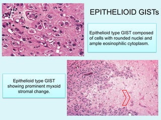 SPINDLE CELL LESIONS OF GIT .pptx