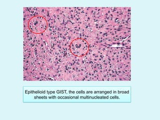 SPINDLE CELL LESIONS OF GIT .pptx