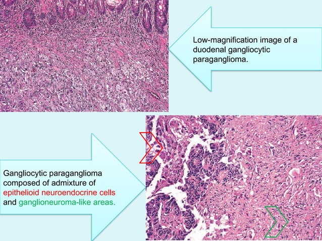 SPINDLE CELL LESIONS OF GIT .pptx | Free Download