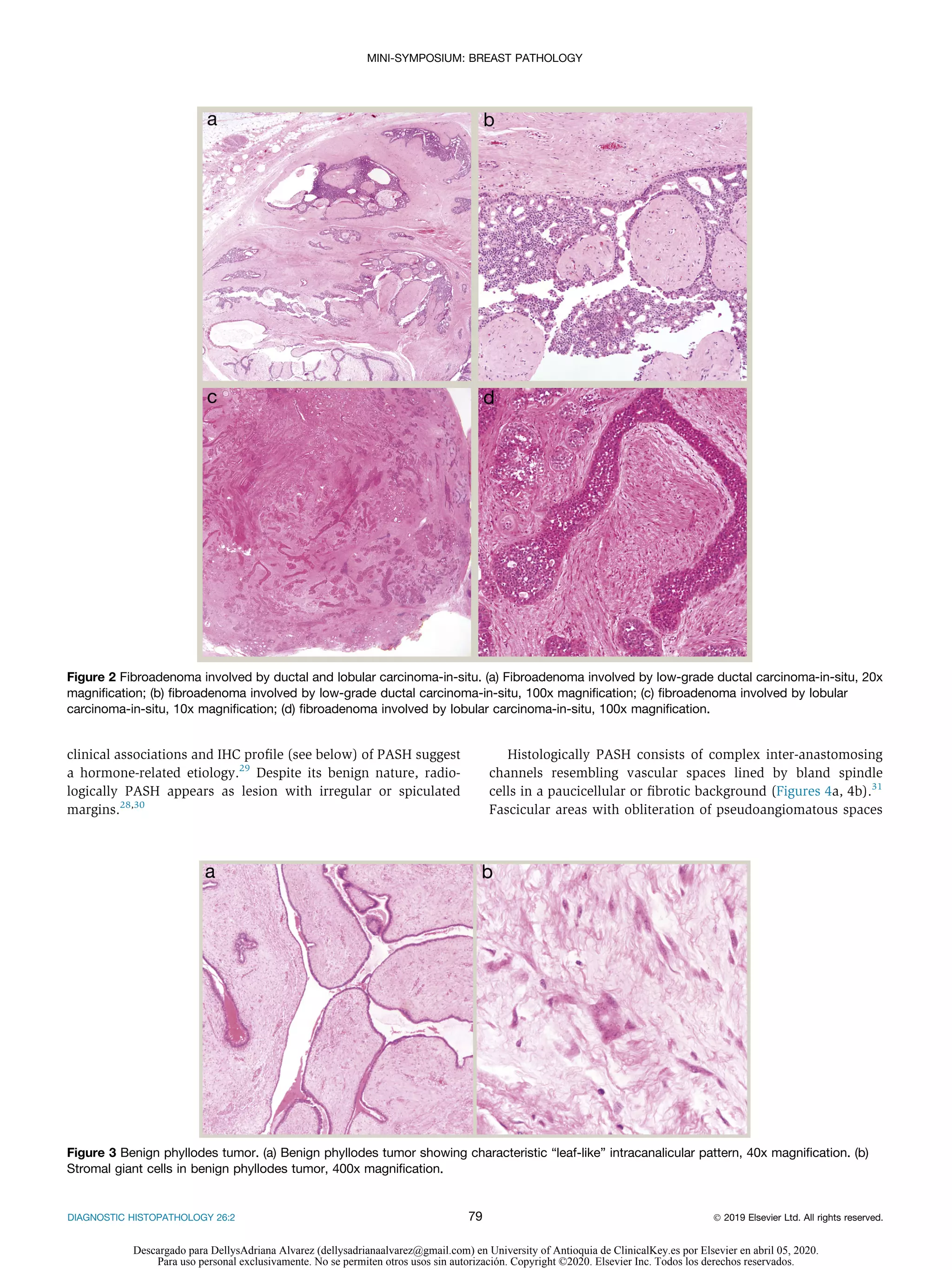 Spindle cell lesions of the breast diagnostic issues 2019 (1) | PDF
