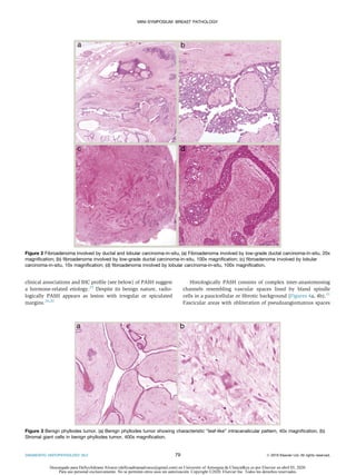 Spindle cell lesions of the breast diagnostic issues 2019 (1) | PDF