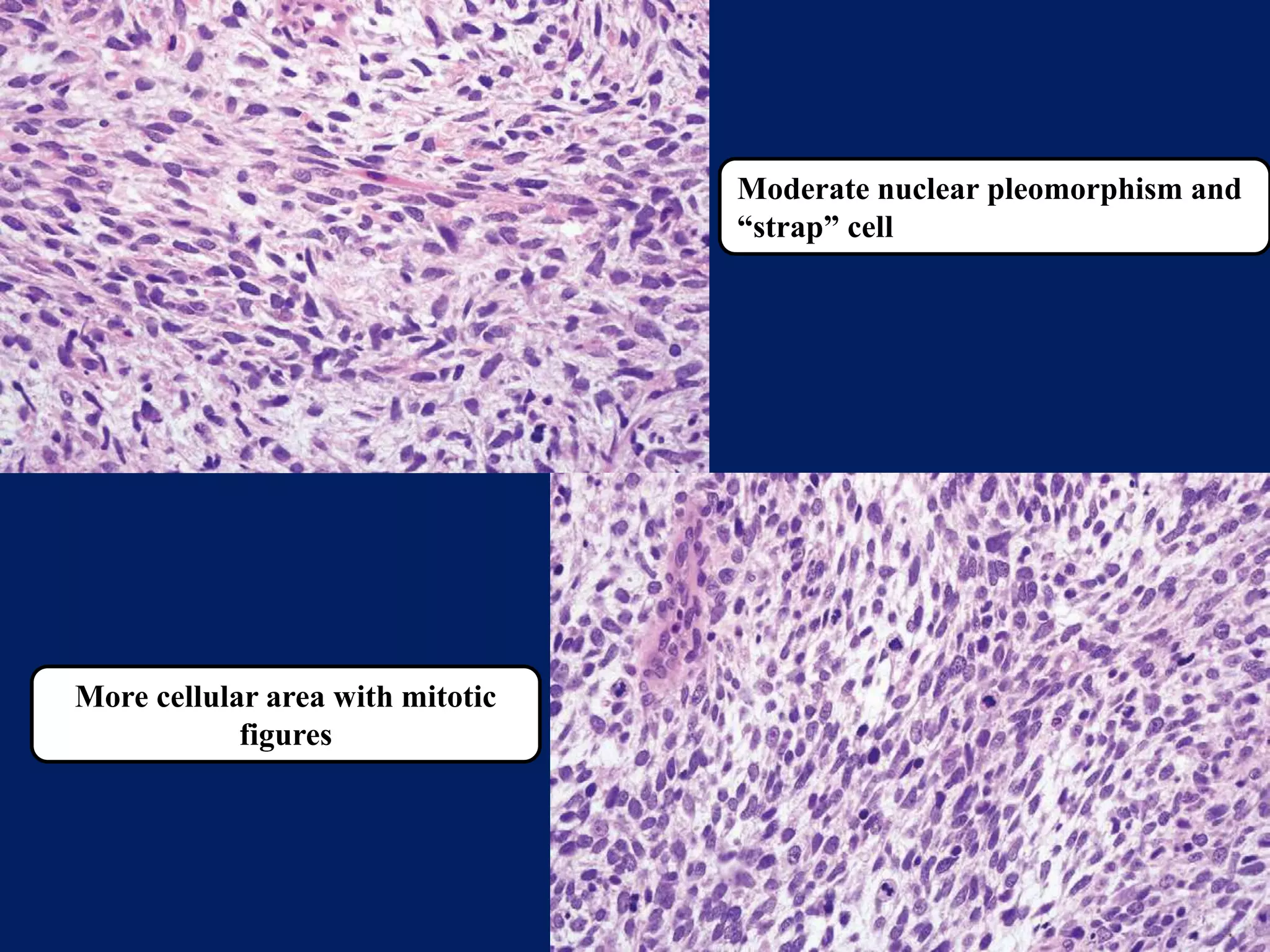 Spindle cell lesions of oral cavity part II | PPTX