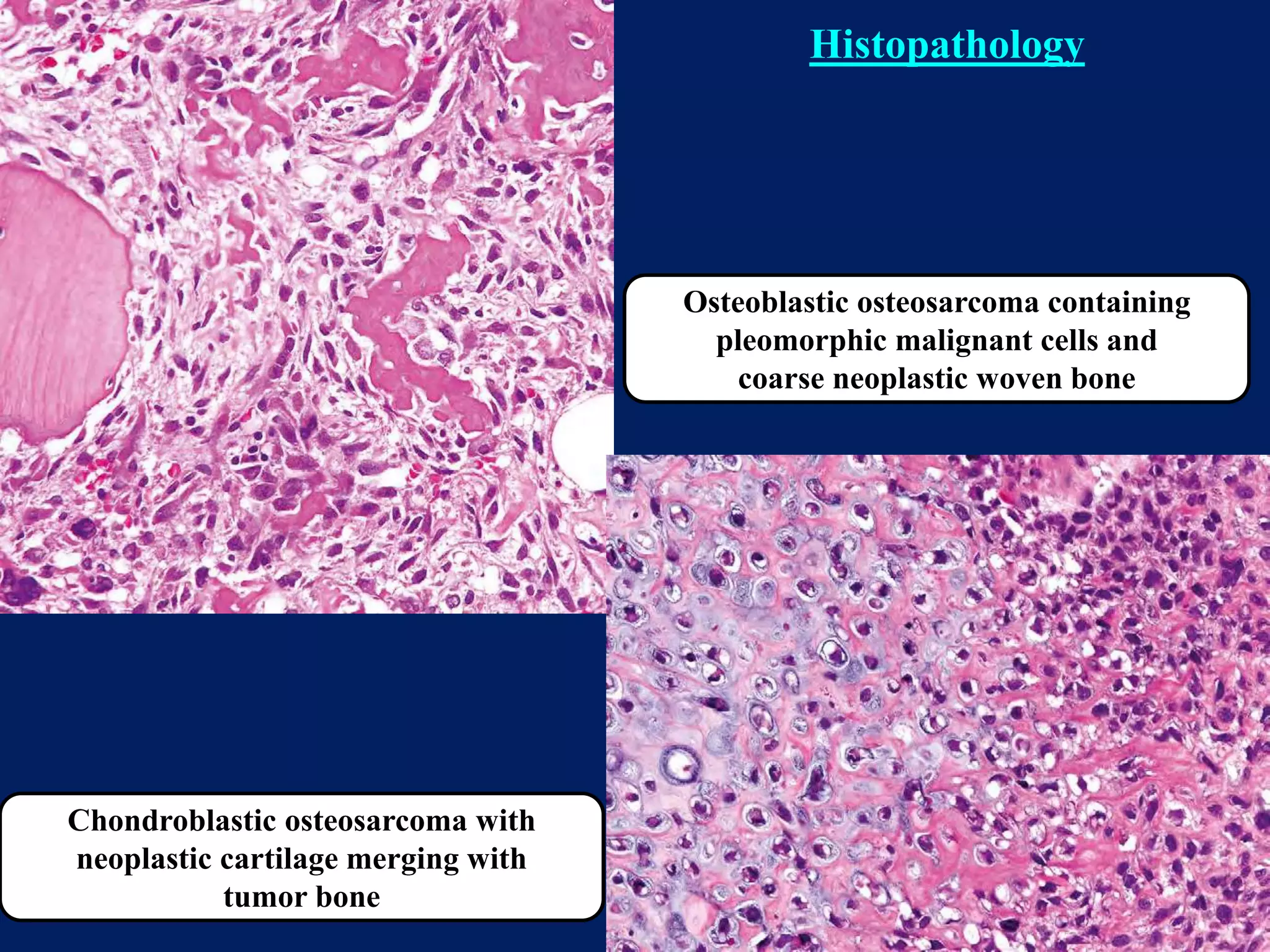 Spindle cell lesions of oral cavity part III | PPTX