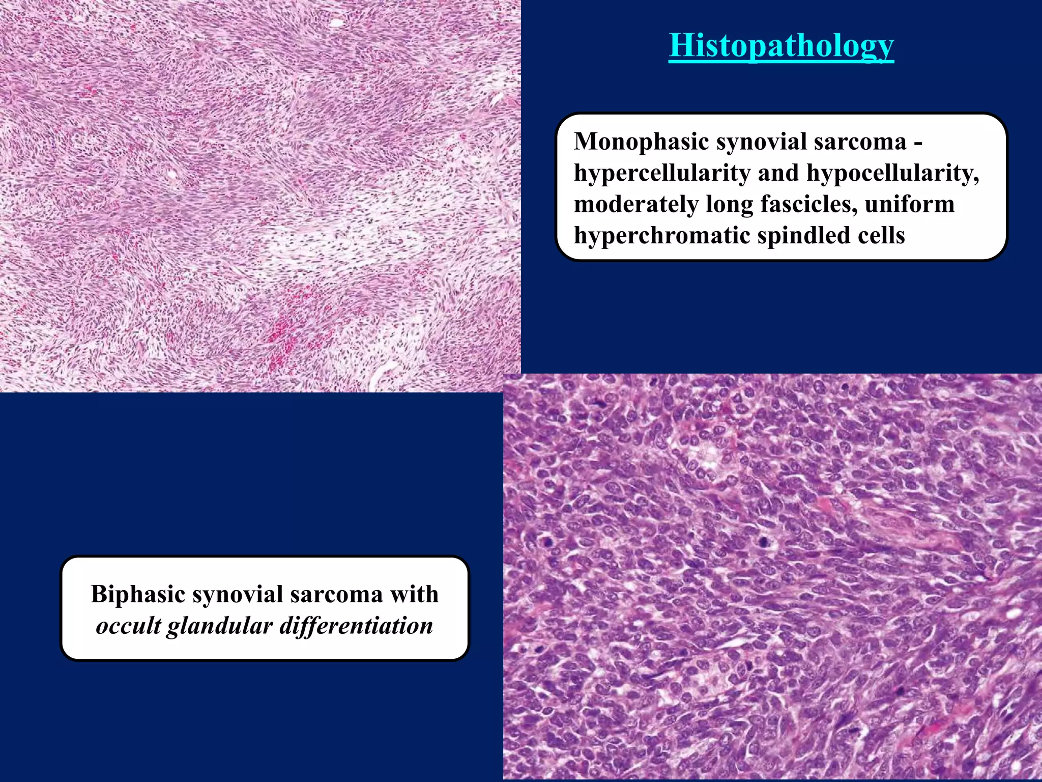 Spindle cell lesions of oral cavity part III | PPTX