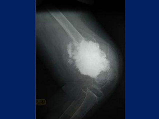 Spindle cell lesions of oral cavity part III | PPTX | Bone and Joint ...