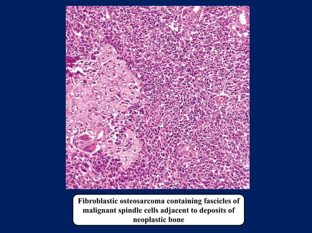 Spindle cell lesions of oral cavity part III | PPTX | Bone and Joint ...
