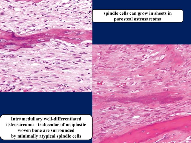 Spindle cell lesions of oral cavity part III | PPTX | Bone and Joint ...
