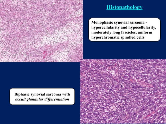 Spindle cell lesions of oral cavity part III | PPTX | Bone and Joint ...