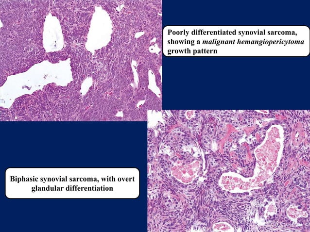 Spindle cell lesions of oral cavity part III | PPTX | Bone and Joint ...