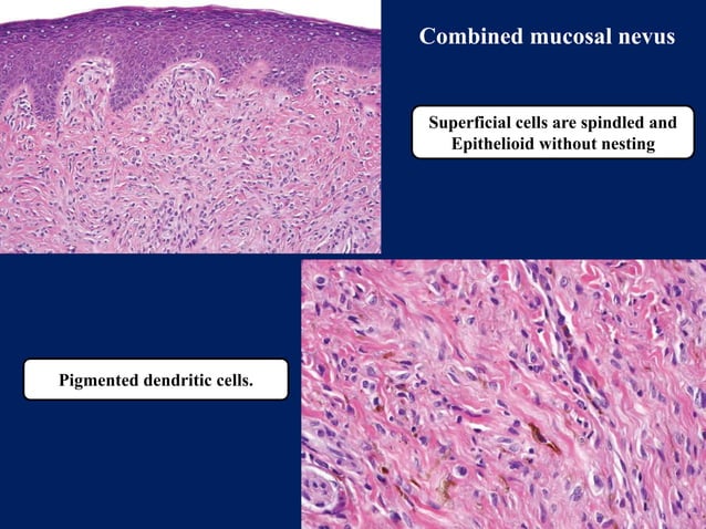 Spindle cell lesions of oral cavity part III | PPTX | Bone and Joint ...