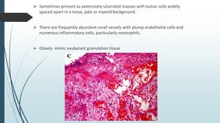 Spindle cell lesions of head & neck | PPTX