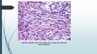 Spindle cell lesions of head & neck | PPTX