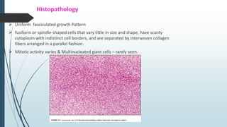 Spindle cell lesions of head & neck | PPTX