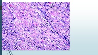 Spindle cell lesions of head & neck | PPTX