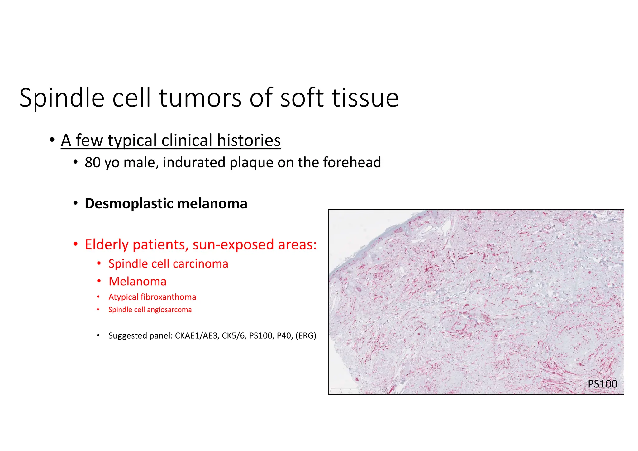 Spindle_Cell_Tumors_of_Soft_Tissue__Dr_de_St-Aubin__11-06-2016.pdf