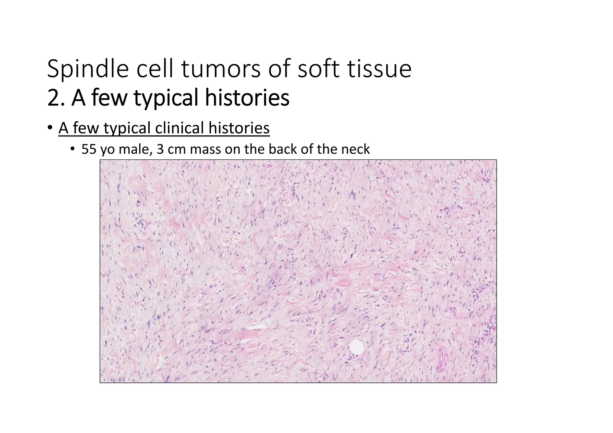 Spindle_Cell_Tumors_of_Soft_Tissue__Dr_de_St-Aubin__11-06-2016.pdf