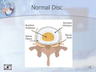 Normal Spine/Normal Disc/Painful Disc/Herniated disc | PPTX