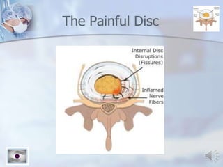Normal Spine/Normal Disc/Painful Disc/Herniated disc | PPTX | Death ...