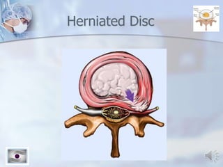Normal Spine/Normal Disc/Painful Disc/Herniated disc | PPTX | Death ...