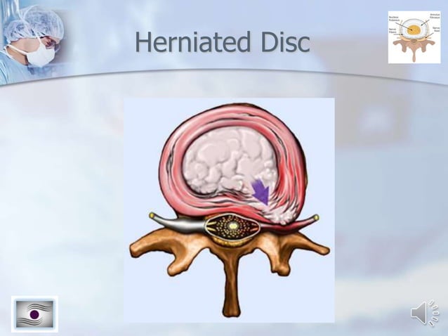 Normal Spine/Normal Disc/Painful Disc/Herniated disc | PPTX | Death ...