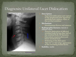 Unilateral Facet Dislocation | PPT
