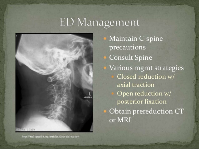 Unilateral Facet Dislocation Cervical Spine Injuries: Part II | 2012-07 ...