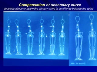 The congenital and acquired diseases of spine | PPT