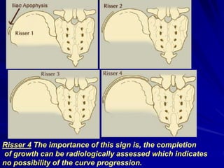 The congenital and acquired diseases of spine | PPT