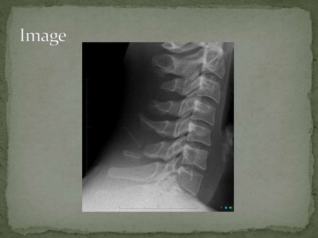 Clay Shoveler's Fracture | PPTX