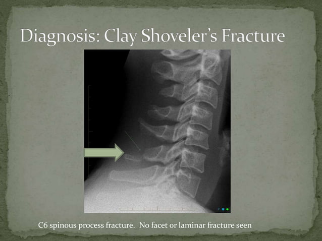 Clay Shoveler's Fracture | PPTX